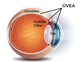 Uveítis - Clínica de Oftalmología de Cali